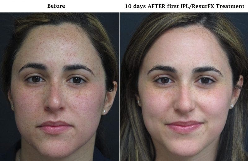 Before and After IPL/ResurFX - Central Florida Dermatology Associates